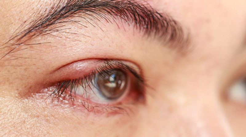 Arpacık Neden Olur? Arpacık nasıl geçer ? – Benim Not Defterim