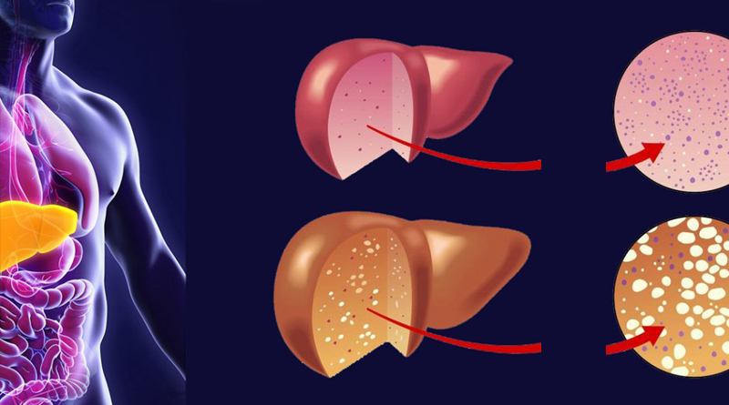 Karaciğer Yağlanması Hastalığı için 10 Evde Çözüm – Benim Not Defterim